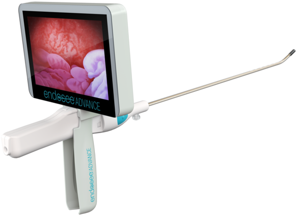 All-in-One Portable, In-office Hysteroscopy Device